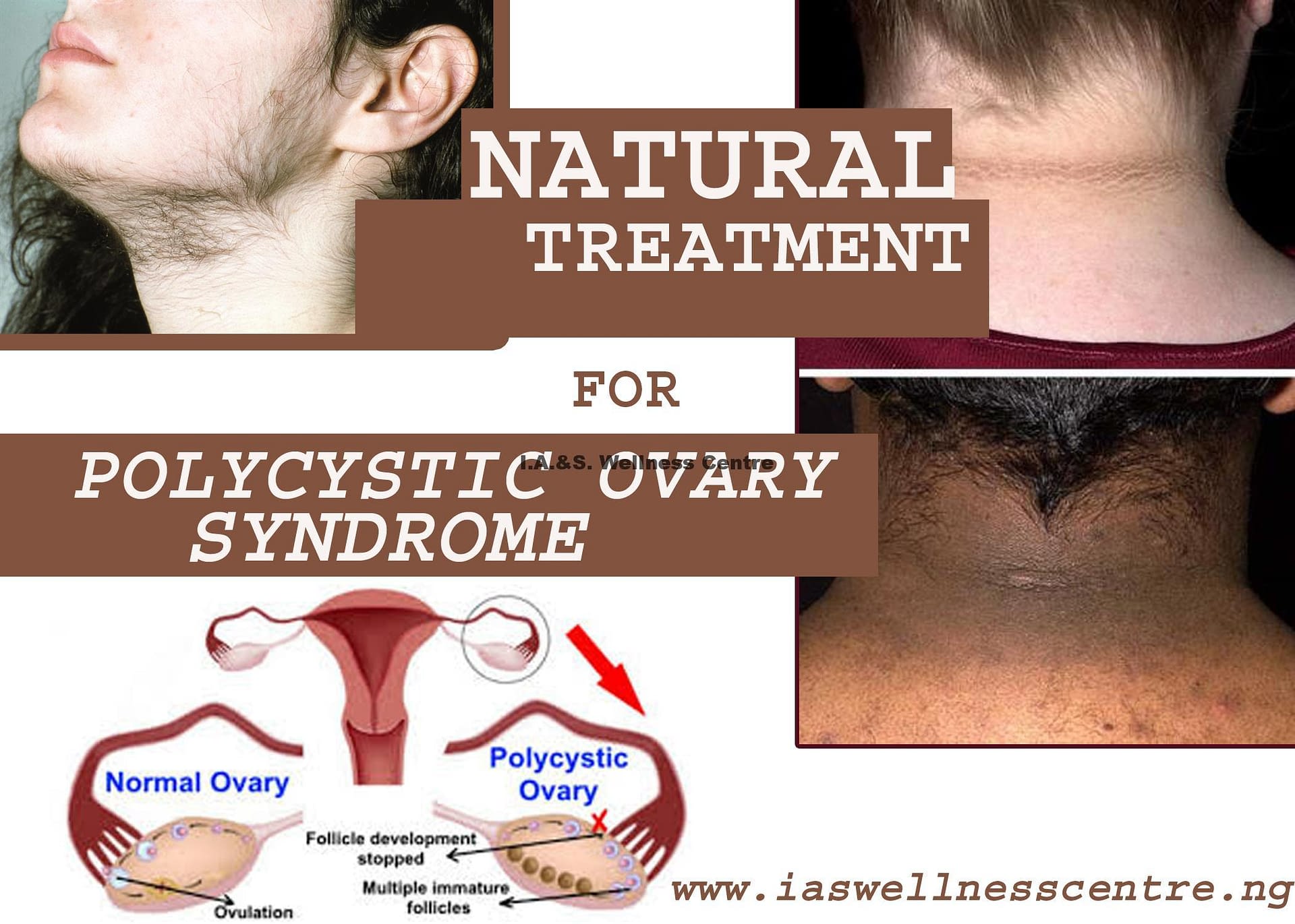POLYCYSTIC OVARY SYNDROME(PCOS) AND IT'S NATURAL TREATMENT IN NIGERIA ...