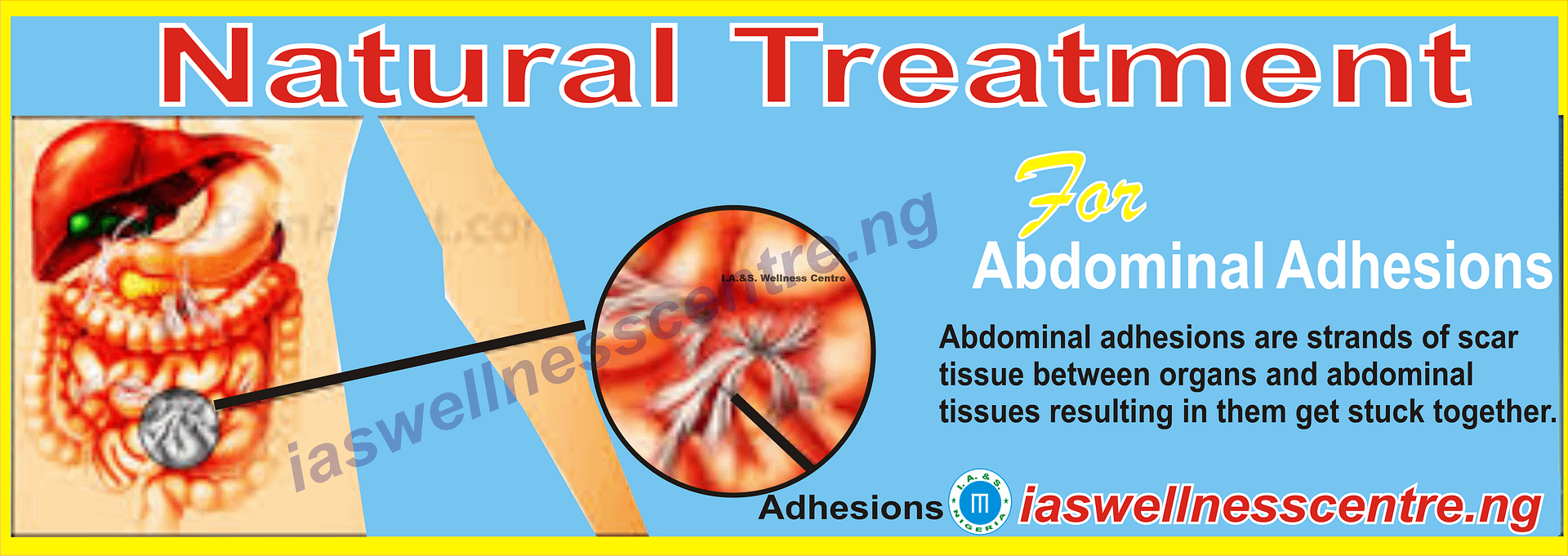 ABDOMINAL ADHESIONS AND IT'S NATURAL TREATMENT IN NIGERIA - I.A.S ...